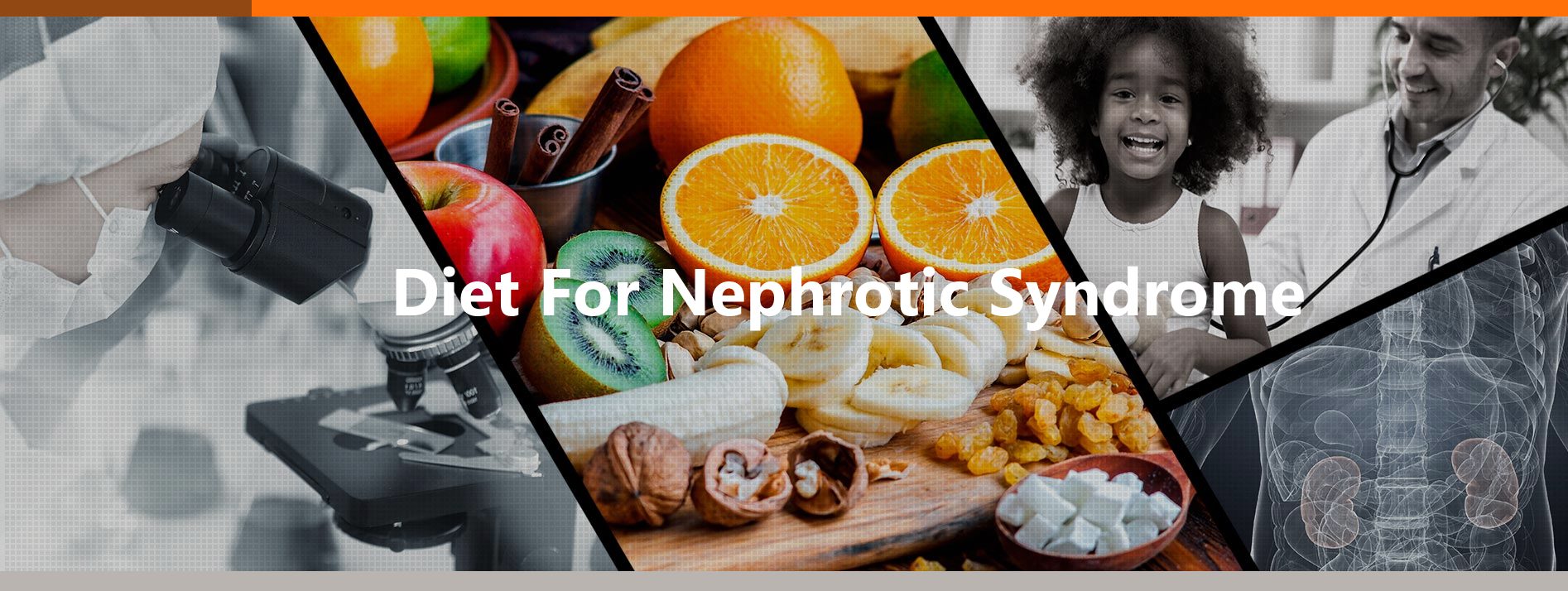 Diet For Nephrotic Syndrome Patients To Follow