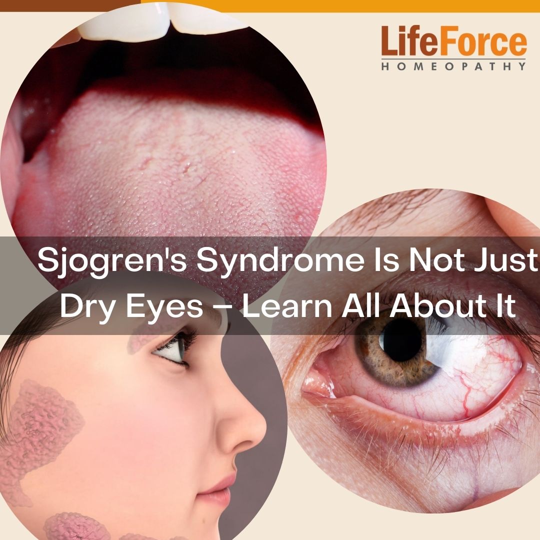 Sjogren's Syndrome Is Not Just Dry Eyes – Learn All About It