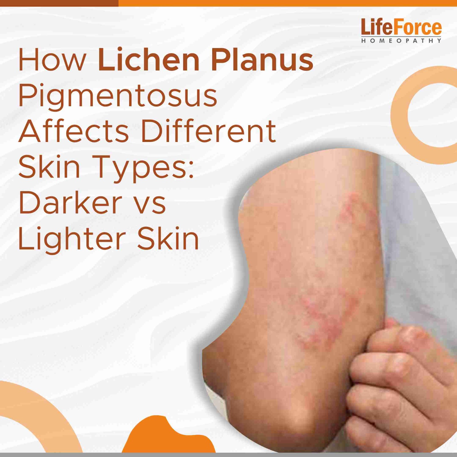 Lichen Planus Pigmentosus: Impact on Different Skin Types