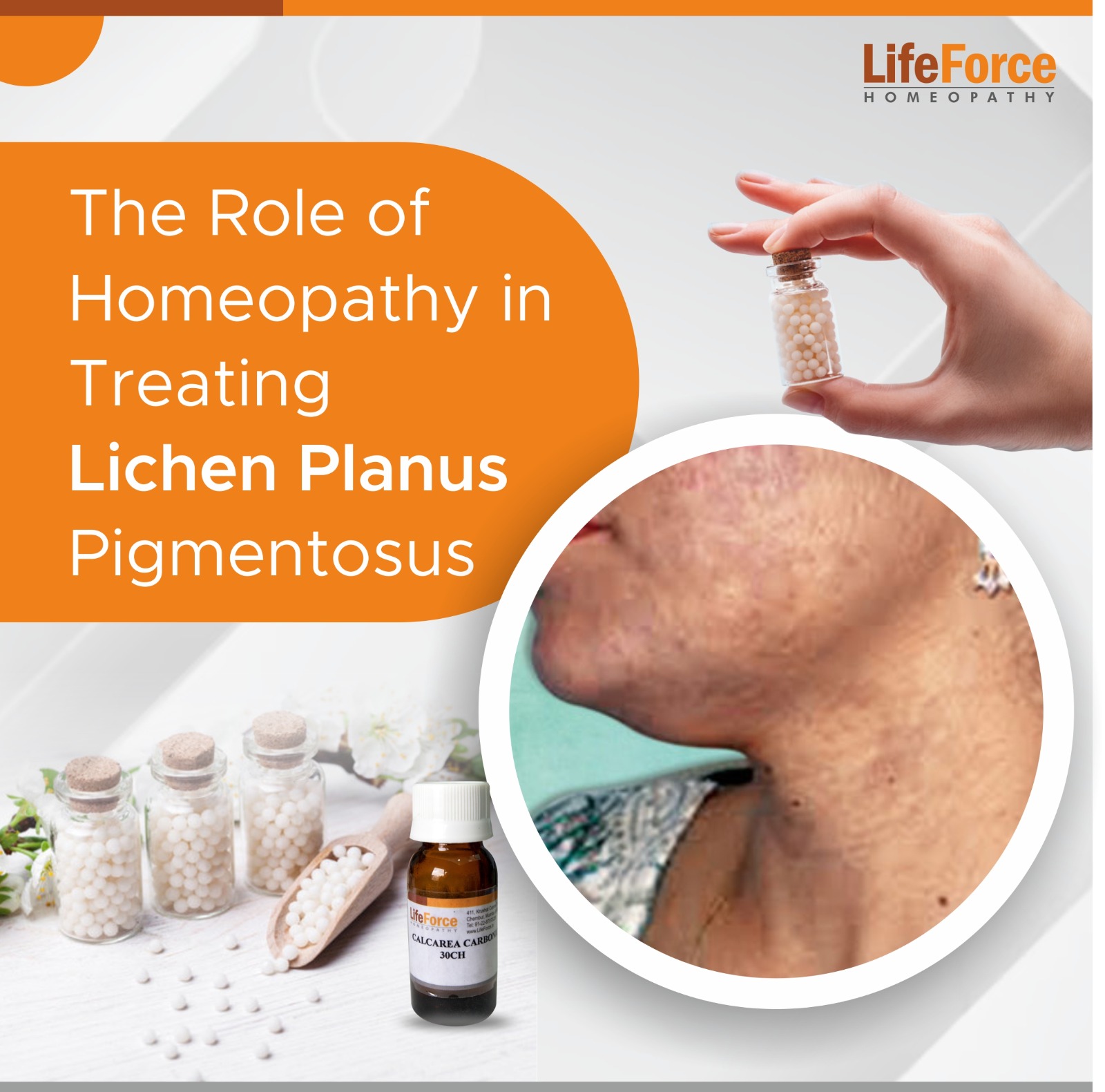 Lichen Planus Pigmentosus Blog | Homeopathic Solutions