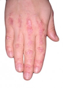 Dermatomyositis | Lifeforce