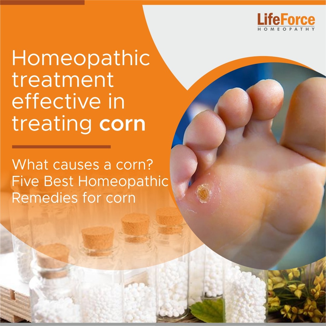 What causes a corn? Five best homeopathic remedies for corn | Lifeforce