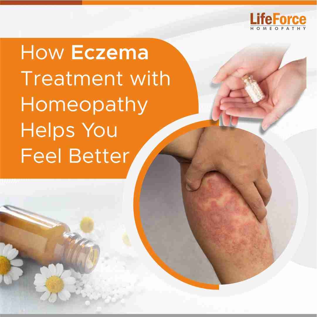 How Eczema Treatment with Homeopathy Helps You Feel Better?